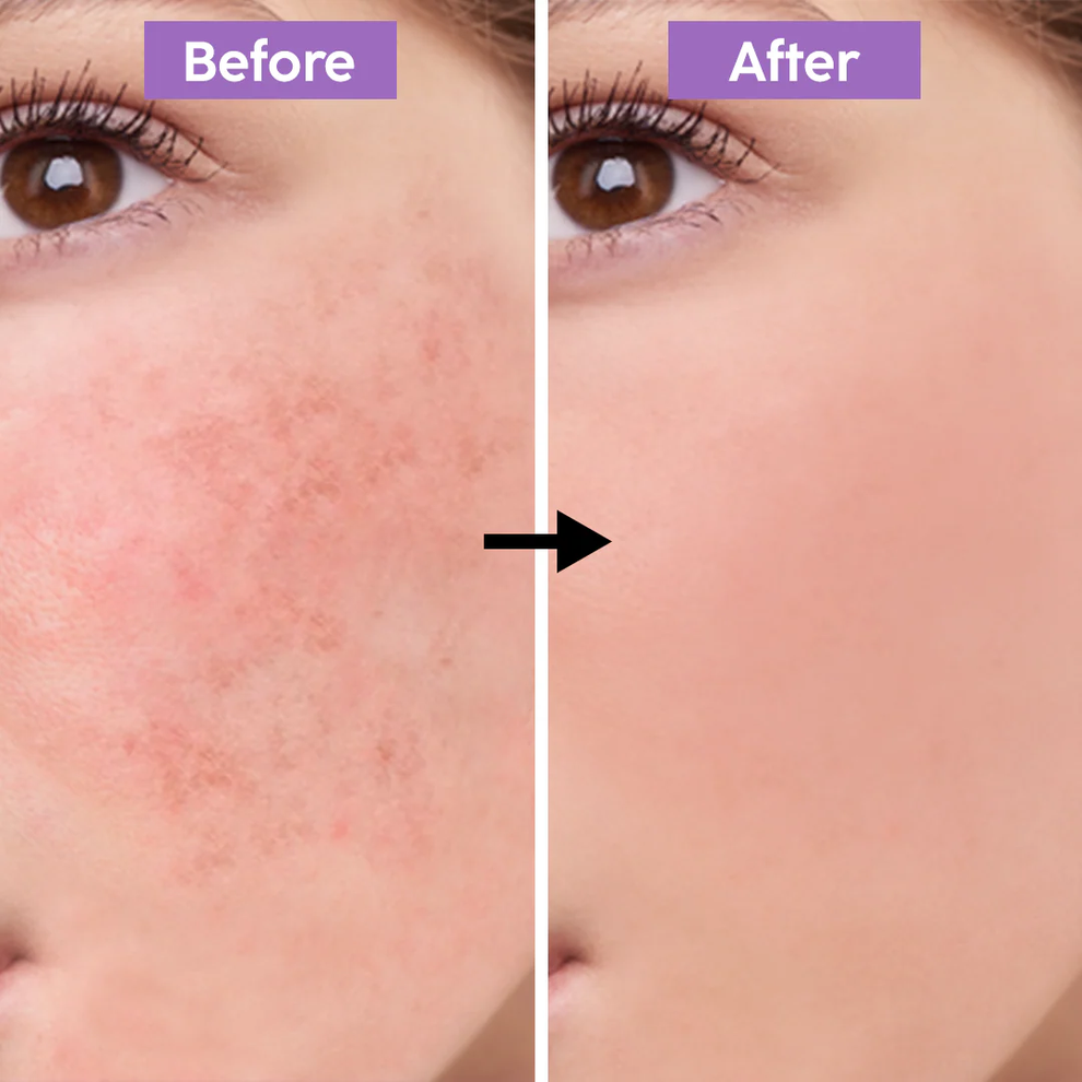 Teashell Niacinamide Brightening Serum | Fade Dark Spots, Acne Marks