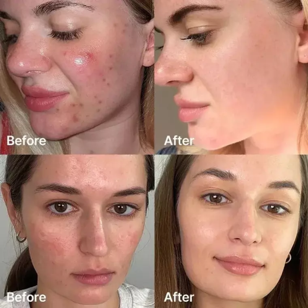 Teashell Niacinamide Brightening Serum | Fade Dark Spots, Acne Marks